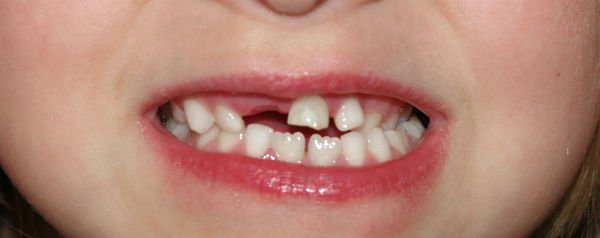 Waarom krijg je eerst een melkgebit? | KIJK Magazine