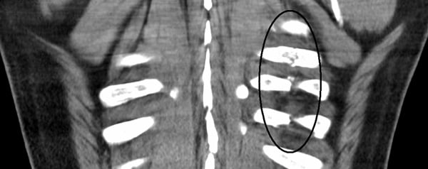 Wat is pijnlijker: een gekneusde of gebroken rib? | KIJK Magazine
