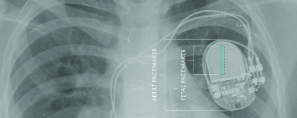 Piepkleine pacemaker kan ongeboren baby’s redden | KIJK Magazine